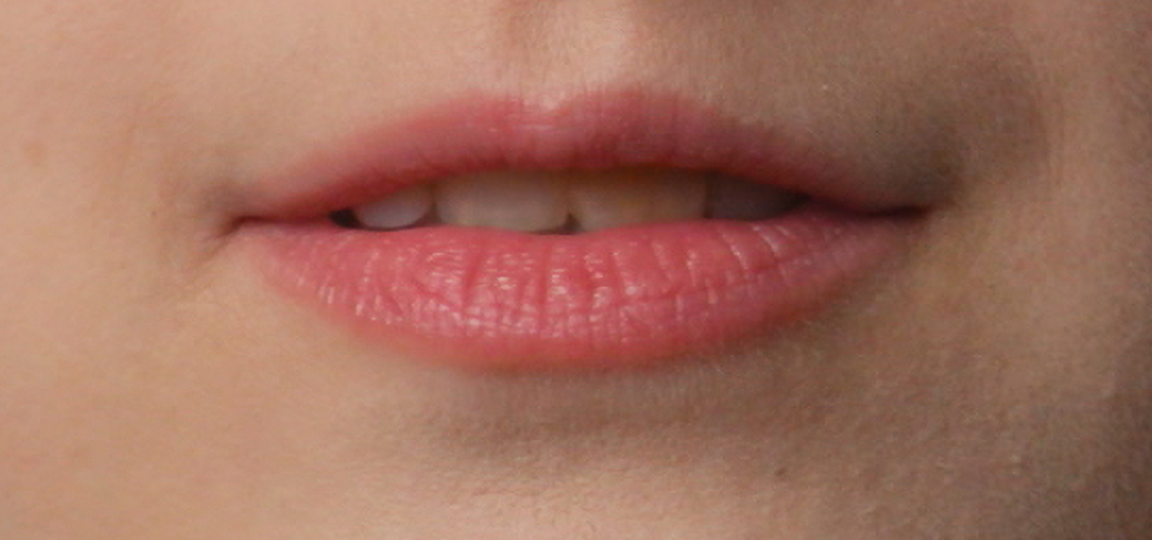 Small Lips Before and After 1 Syringe of Juvederm - Dkdermal